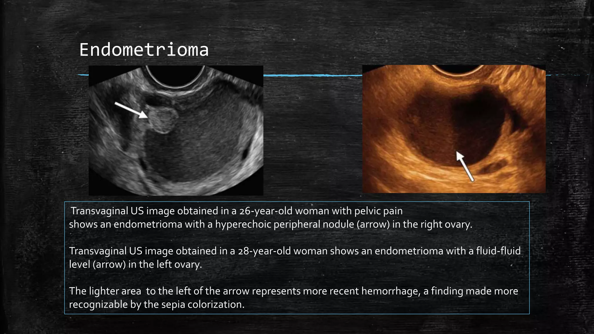 Uterine Myoma, Endometriosis, Endometrial Ca and.pptx
