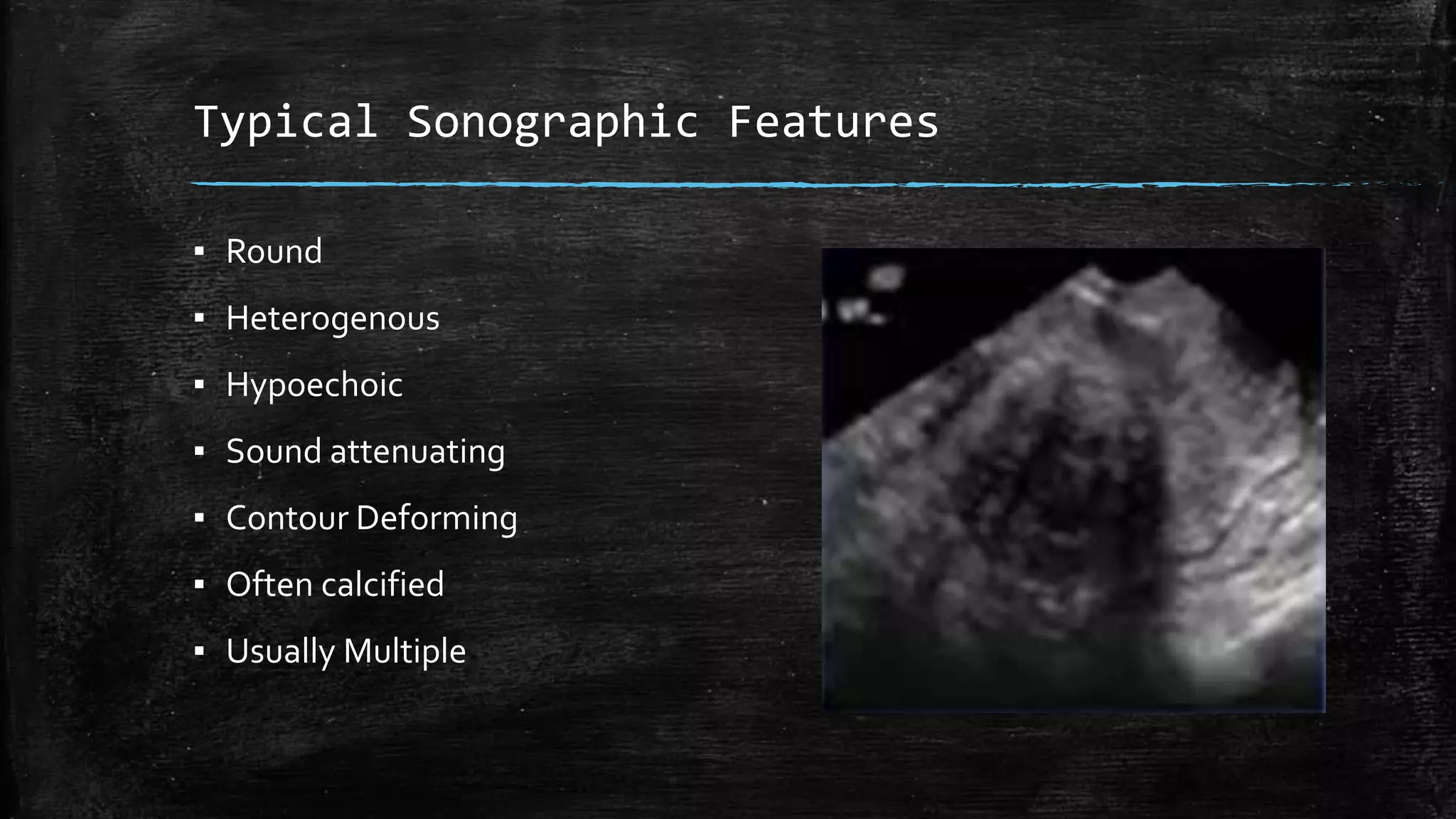 Uterine Myoma, Endometriosis, Endometrial Ca and.pptx