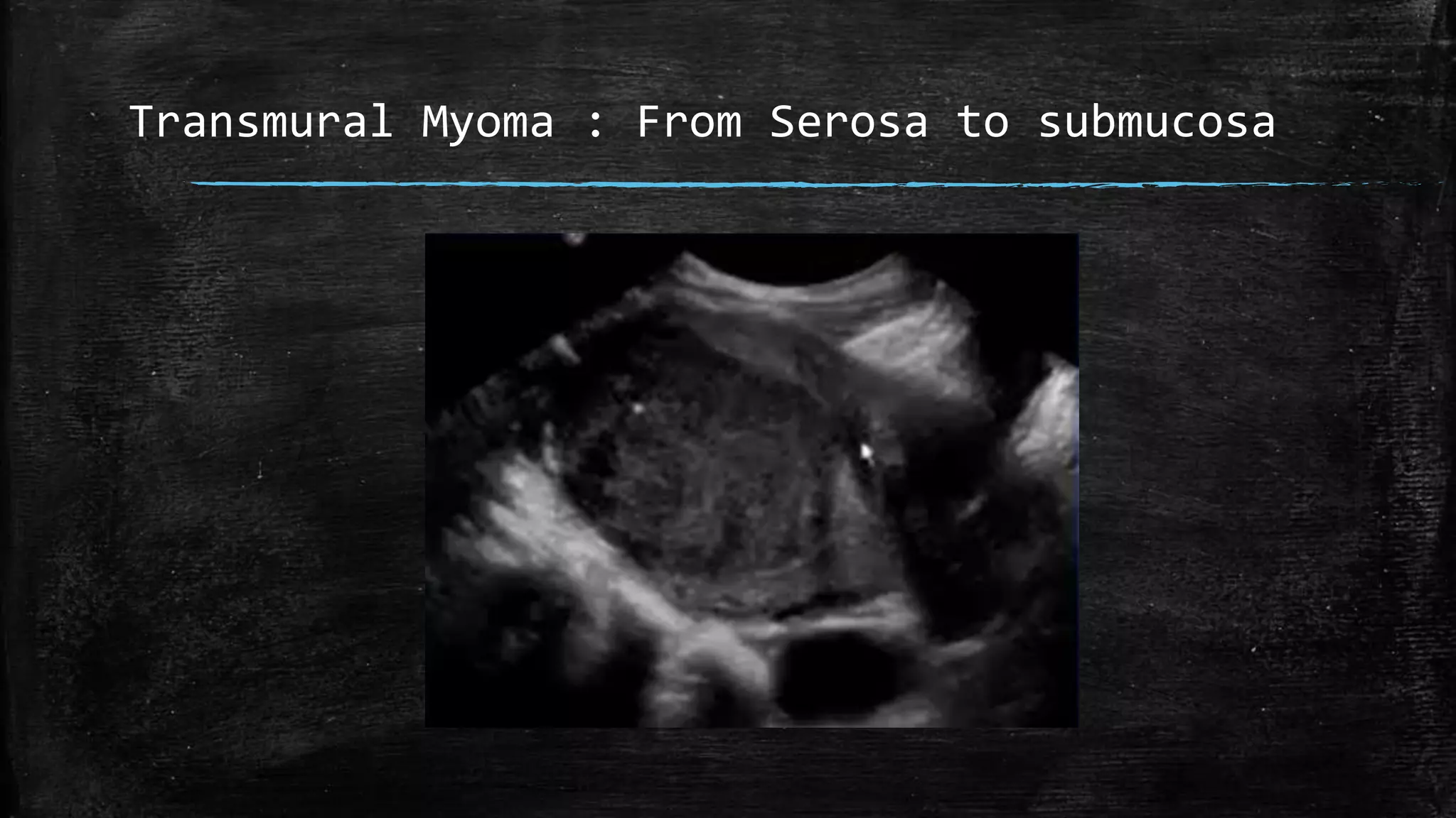 Uterine Myoma, Endometriosis, Endometrial Ca and.pptx