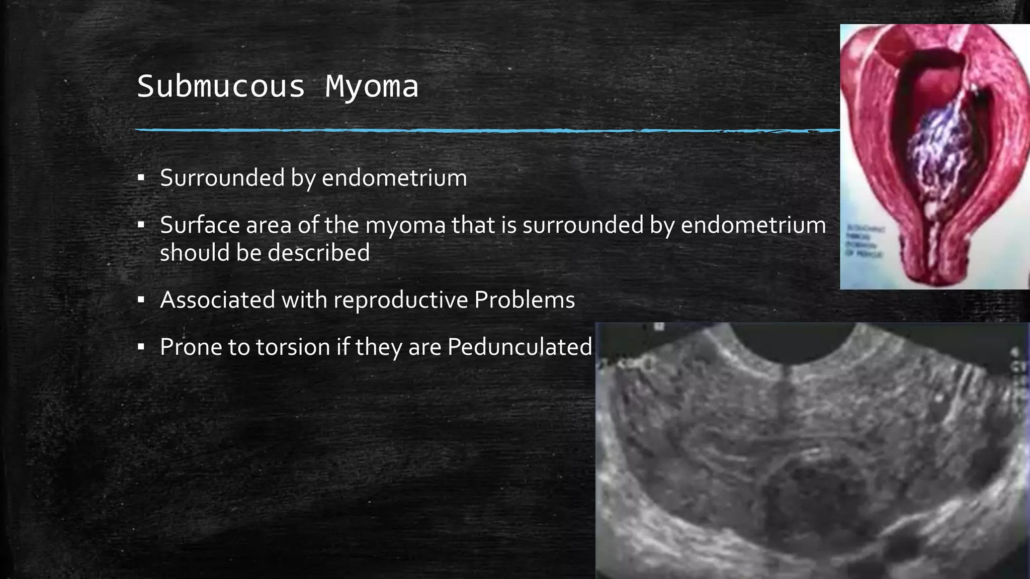 Uterine Myoma, Endometriosis, Endometrial Ca and.pptx