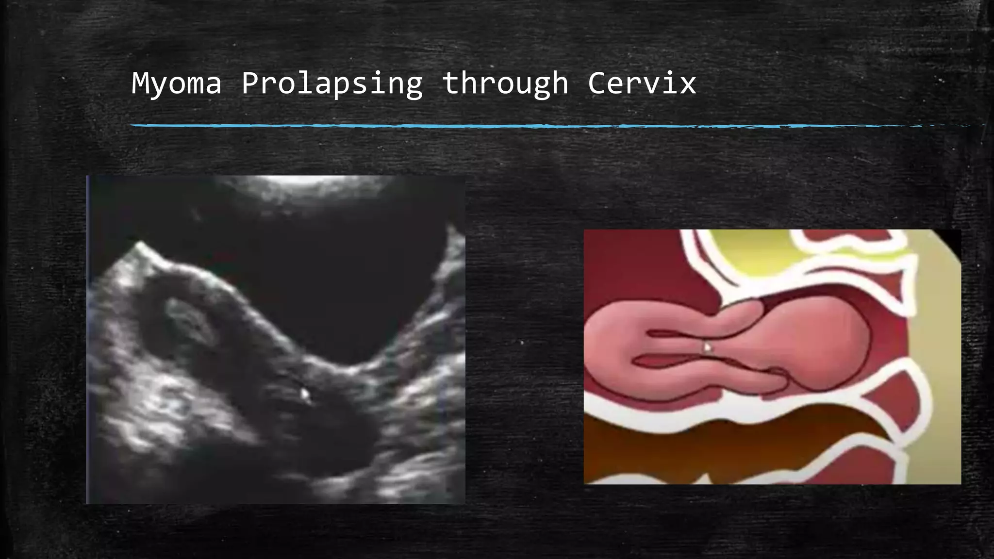 Uterine Myoma, Endometriosis, Endometrial Ca and.pptx