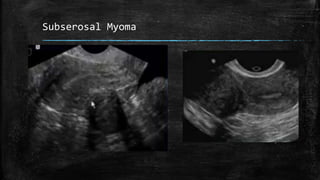 Uterine Myoma, Endometriosis, Endometrial Ca and.pptx