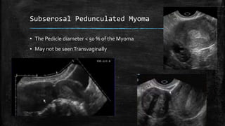 Uterine Myoma, Endometriosis, Endometrial Ca and.pptx