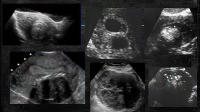 Uterine Myoma, Endometriosis, Endometrial Ca and.pptx