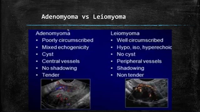 Uterine Myoma, Endometriosis, Endometrial Ca and.pptx