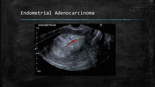 Uterine Myoma, Endometriosis, Endometrial Ca and.pptx