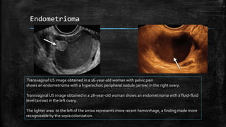 Uterine Myoma, Endometriosis, Endometrial Ca and.pptx