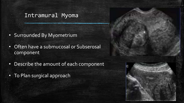 Uterine Myoma, Endometriosis, Endometrial Ca and.pptx