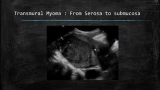 Uterine Myoma, Endometriosis, Endometrial Ca and.pptx
