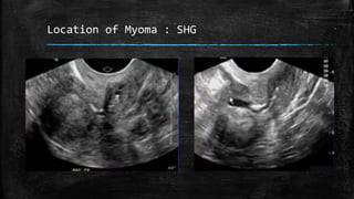 Uterine Myoma, Endometriosis, Endometrial Ca and.pptx