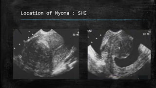 Uterine Myoma, Endometriosis, Endometrial Ca and.pptx