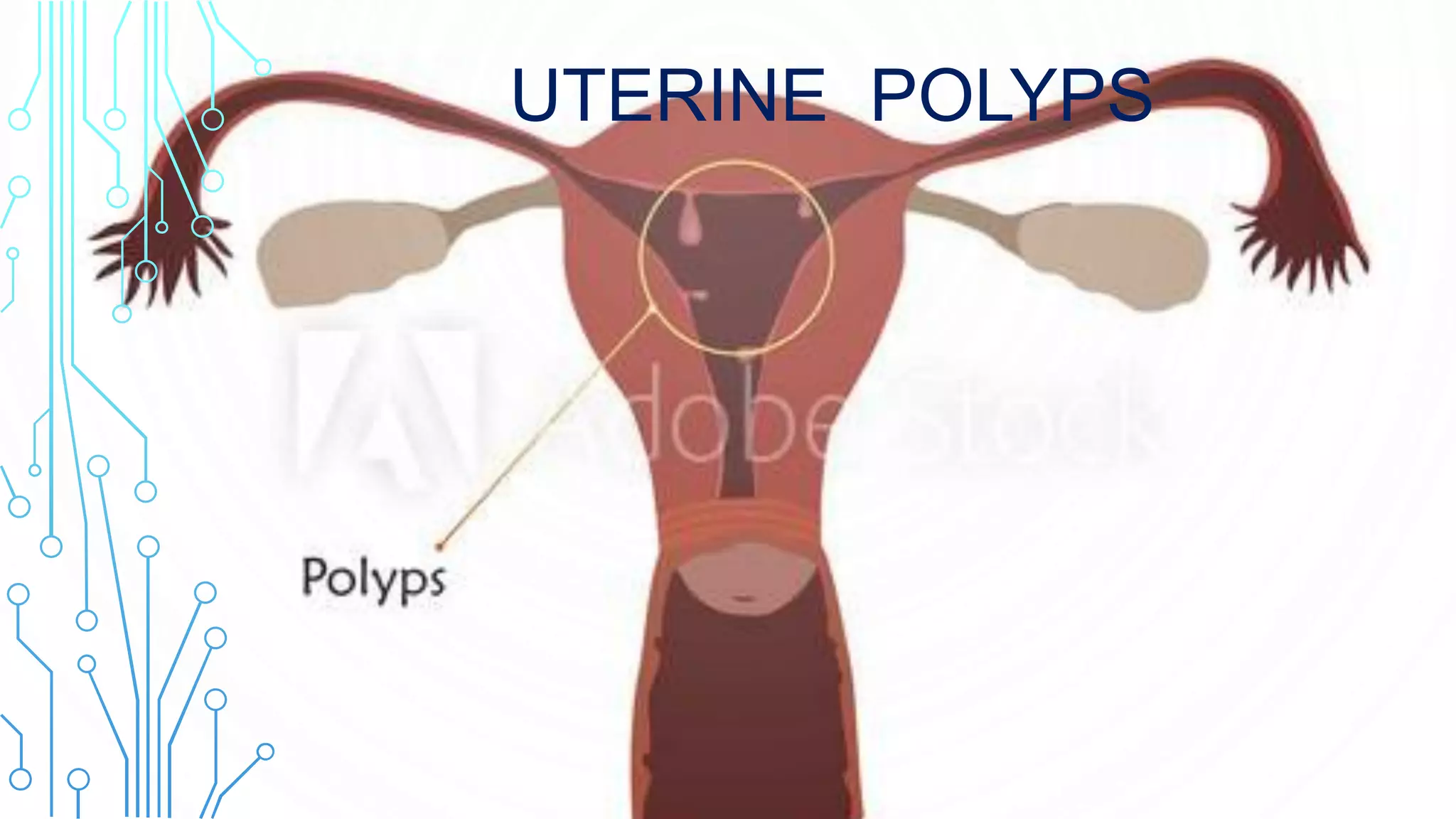 Uterine polyps | PPTX