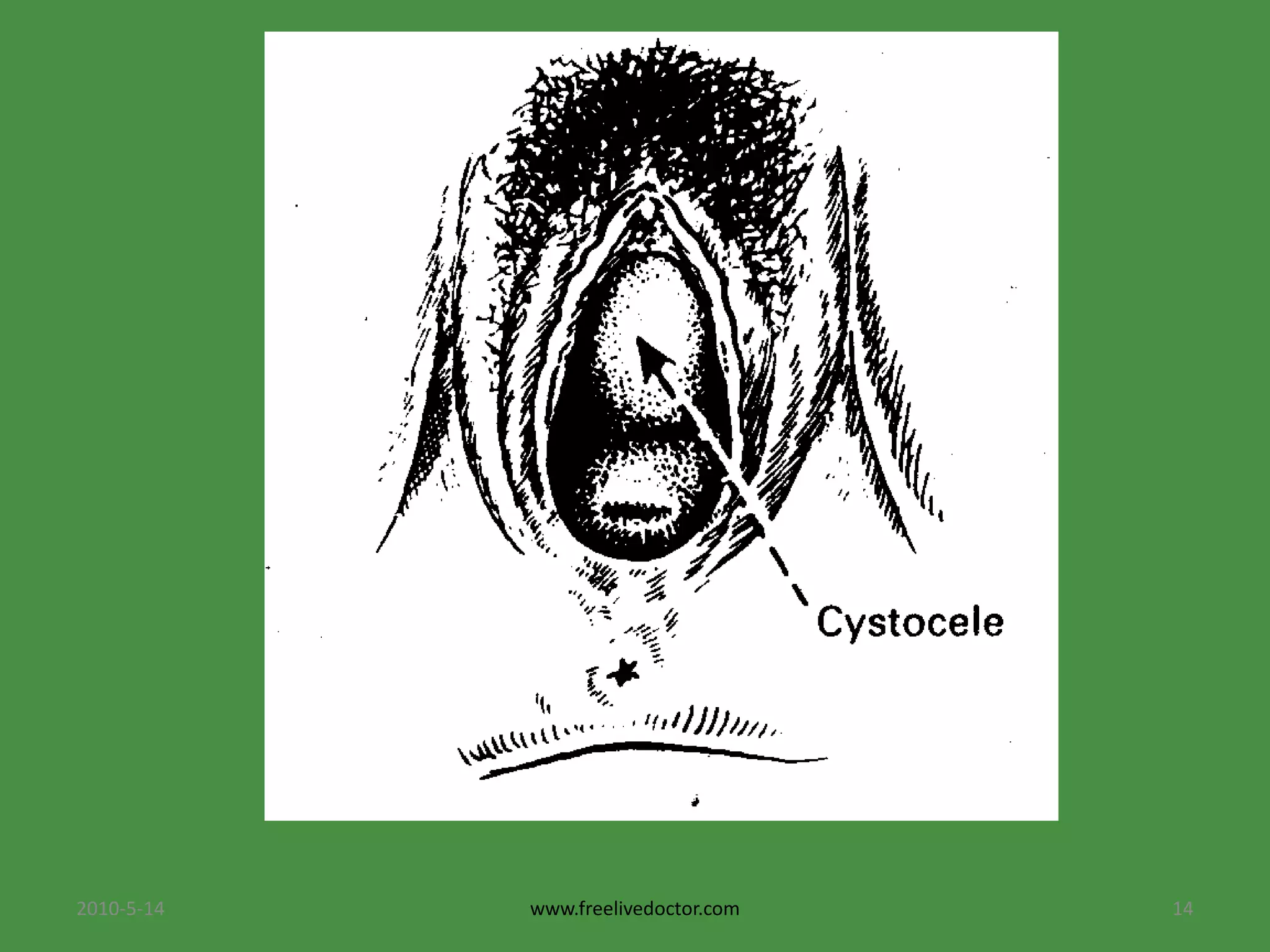 Uterine Prolapse Ppt