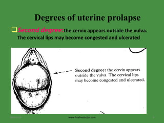 Uterine prolapse | PPTX