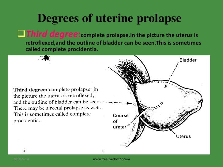 Uterine prolapse
