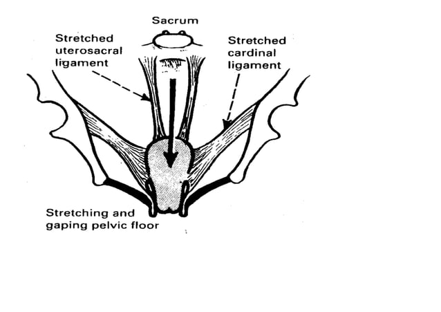 uterineprolapse-130223183535-phpapp02.pdf