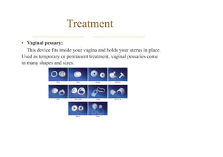 uterineprolapse-130223183535-phpapp02.pdf