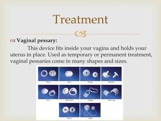 Uterine prolapse | PPTX