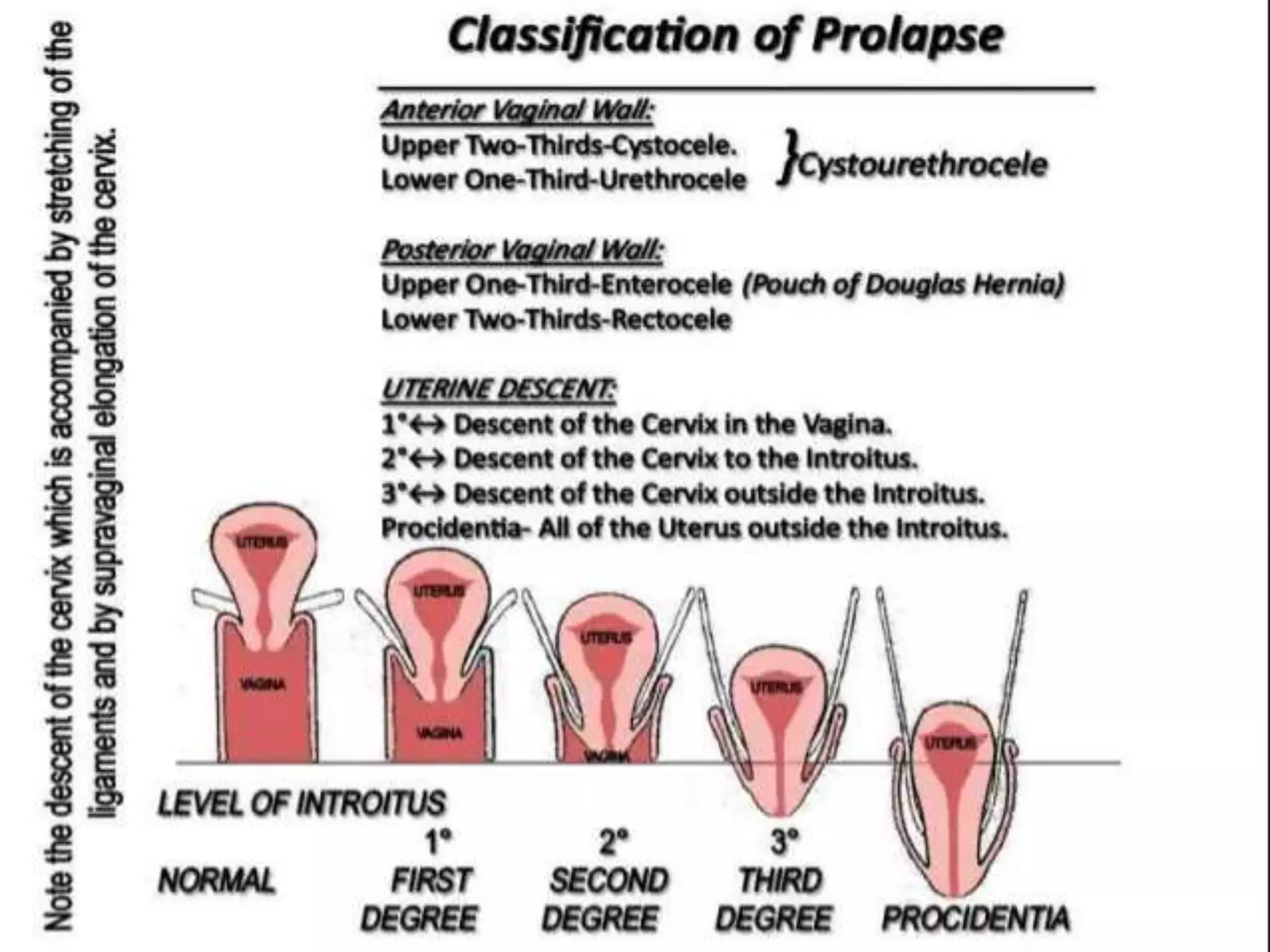 Uterine prolapse | PPTX