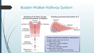 Uterine prolapse with definition, stages,management | PPTX