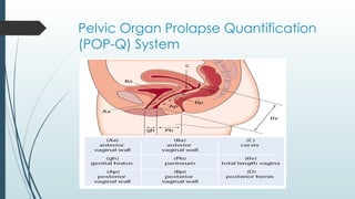 Uterine prolapse with definition, stages,management | PPTX