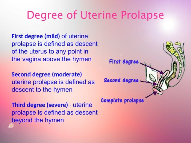 uterine prolapse in displacement final.ppt | Pregnancy | Reproductive ...