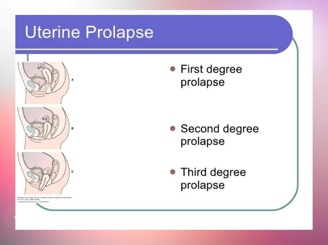 uterine prolapse in displacement final.ppt | Pregnancy | Reproductive ...