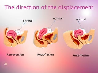 uterine prolapse in displacement final.ppt