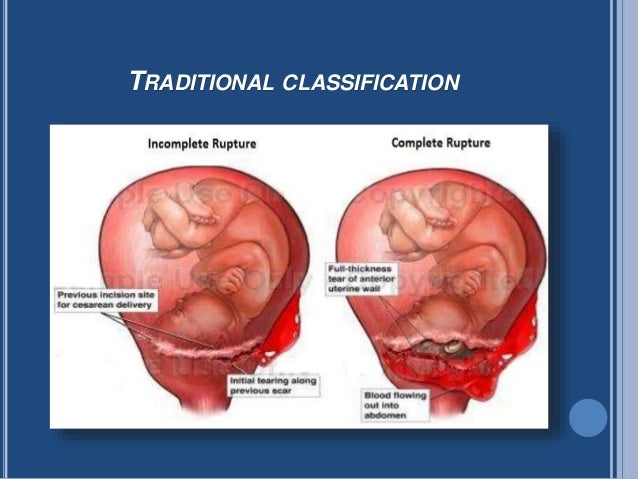 Uterine rupture - All you need to know.