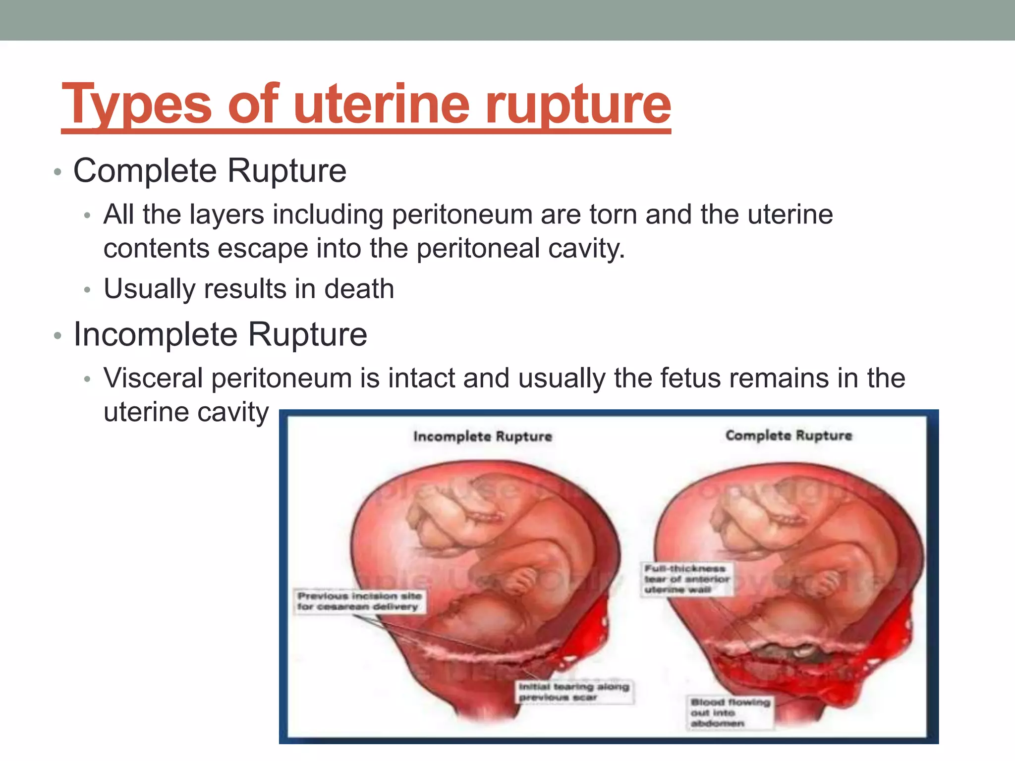 Uterine rupture | PPTX