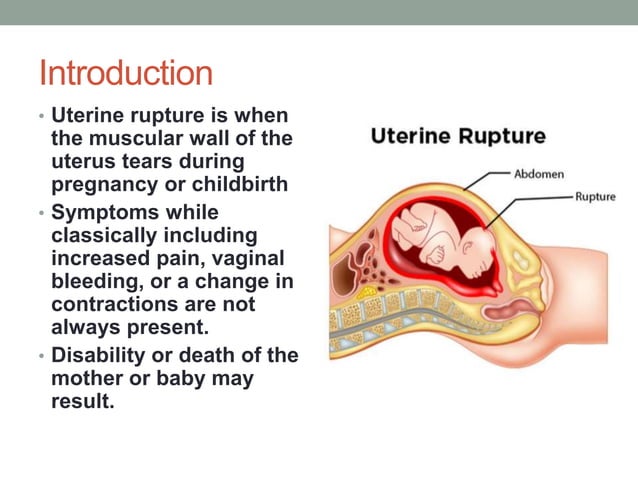 Uterine rupture | PPTX | Pregnancy | Reproductive Health