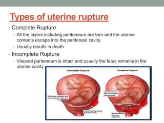 Uterine rupture | PPTX