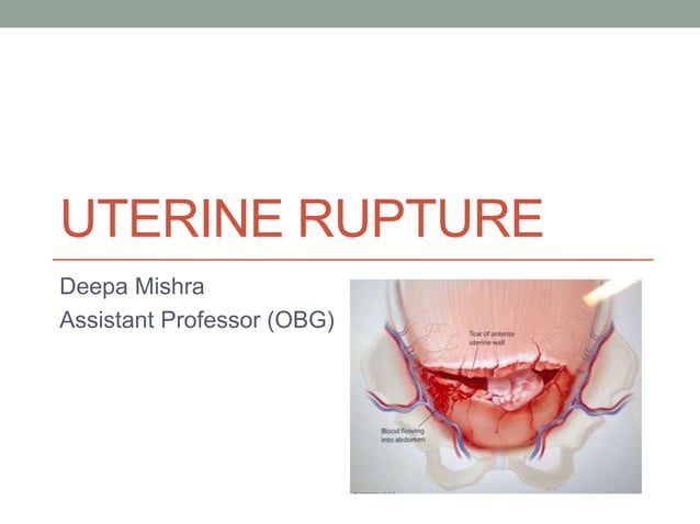 Uterine rupture | PPT