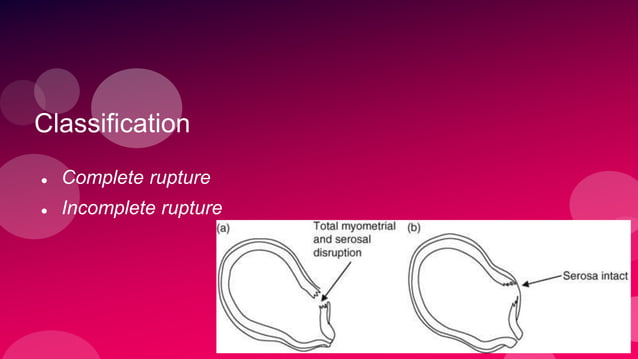 Uterine rupture.ppt | Pregnancy | Reproductive Health