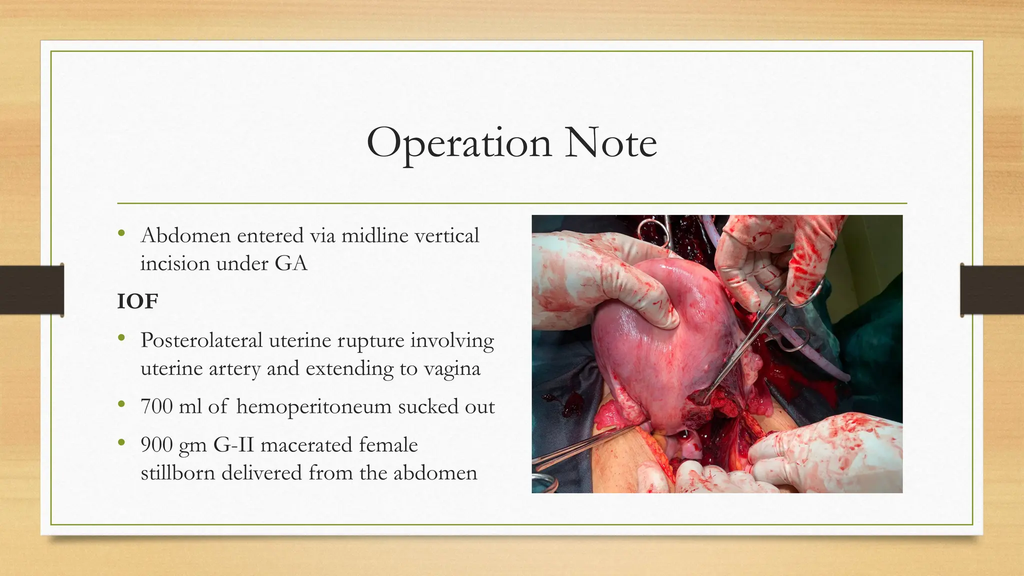Uterine rupture with case description and scientific background | PPTX
