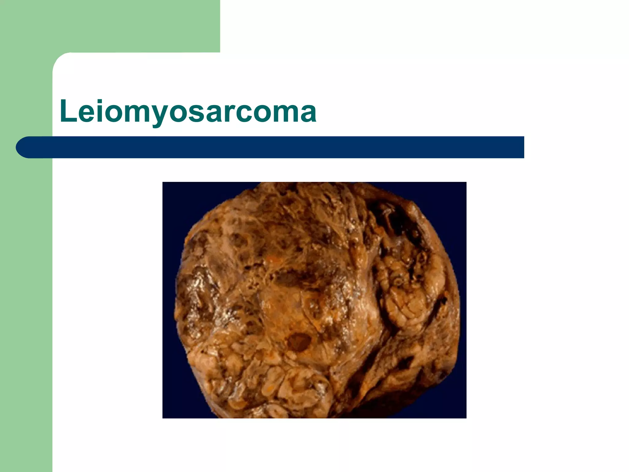Uterine sarcoma | PPT