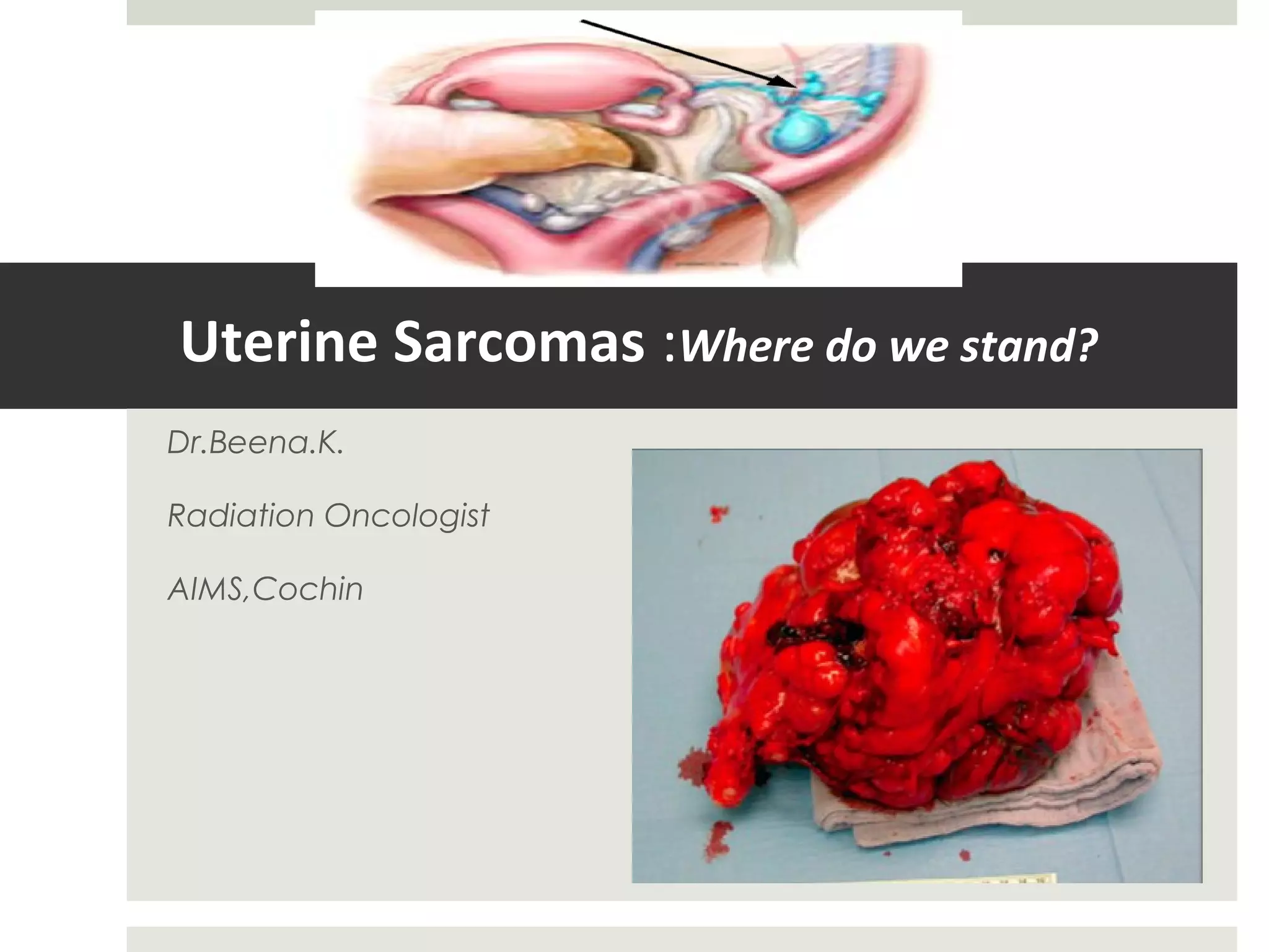Uterine sarcoma | PPT