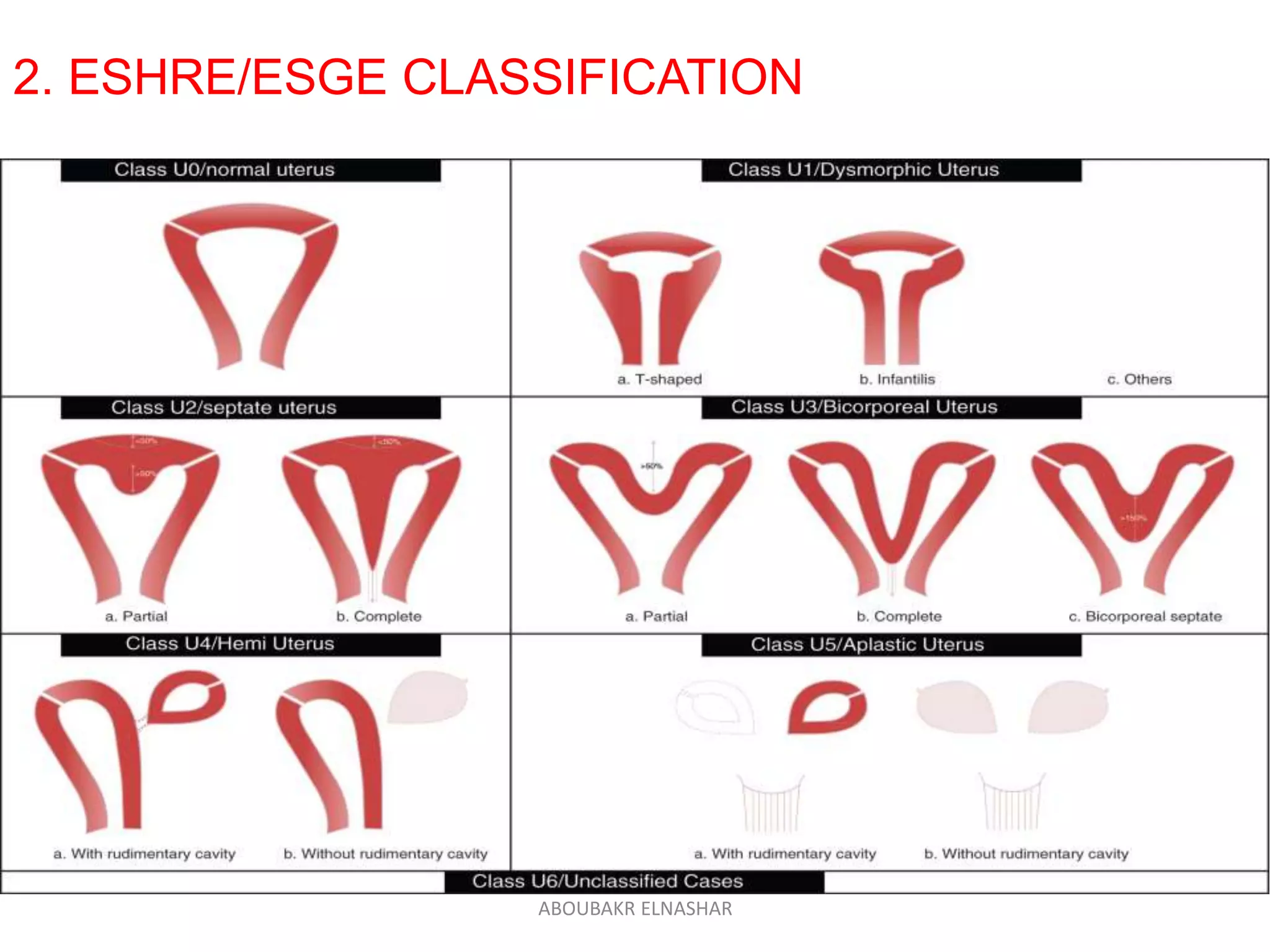 Uterine septum ASRM GUIDELINES2016 | PPSX