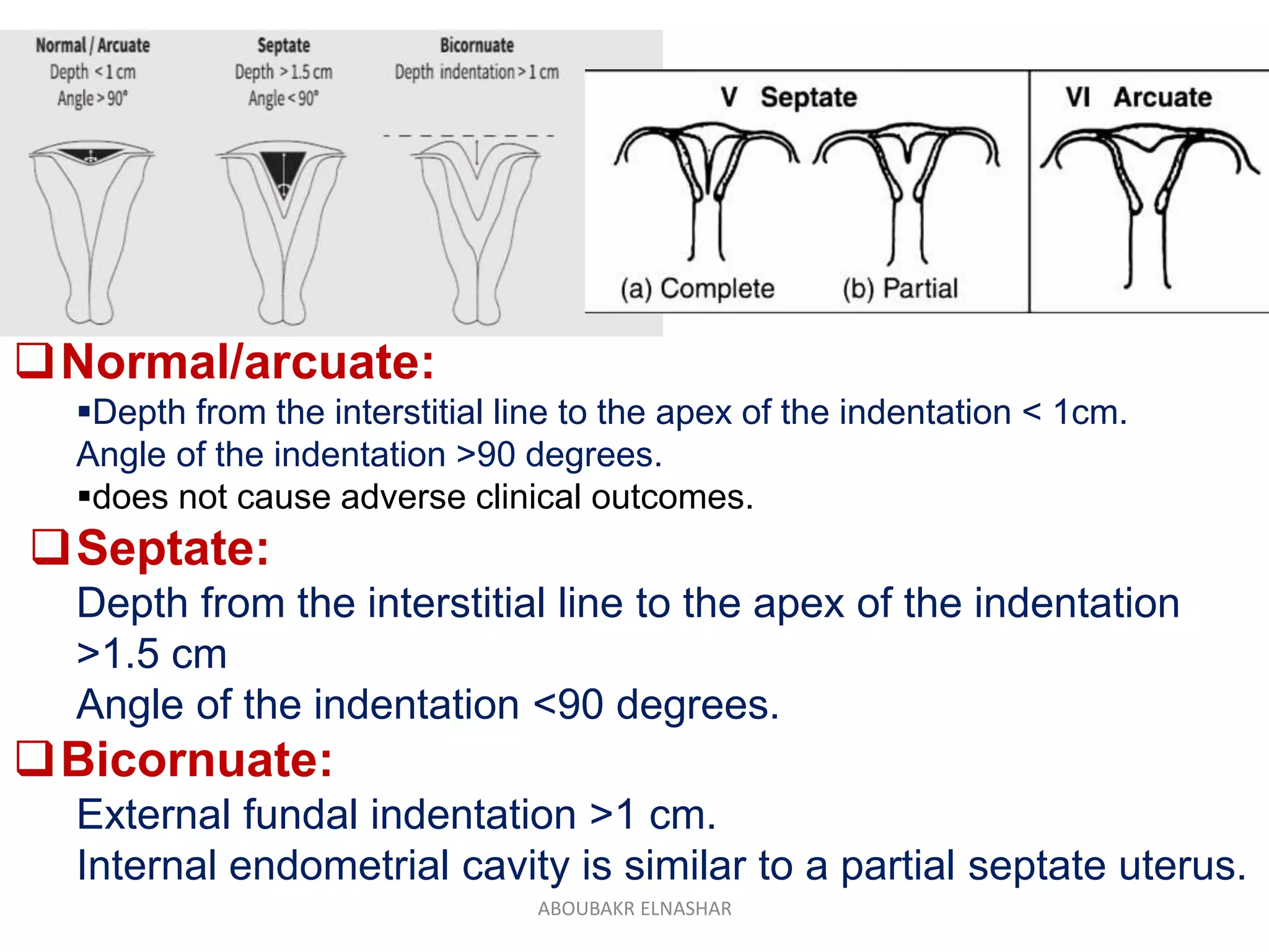 Uterine septum ASRM GUIDELINES2016 | PPSX
