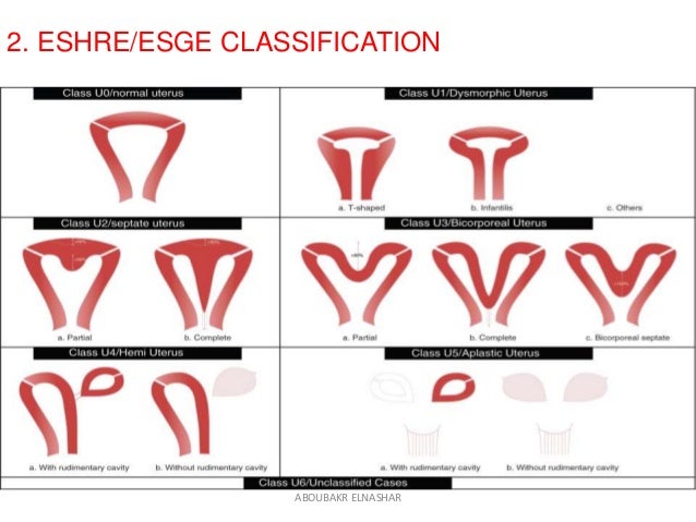 Uterine septum ASRM GUIDELINES2016