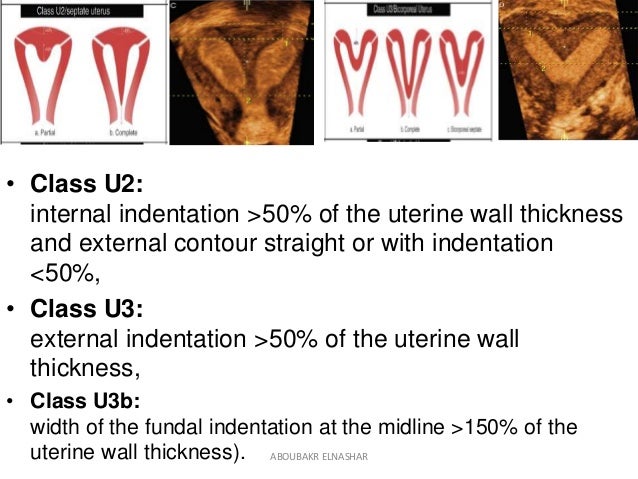 Uterine septum ASRM GUIDELINES2016