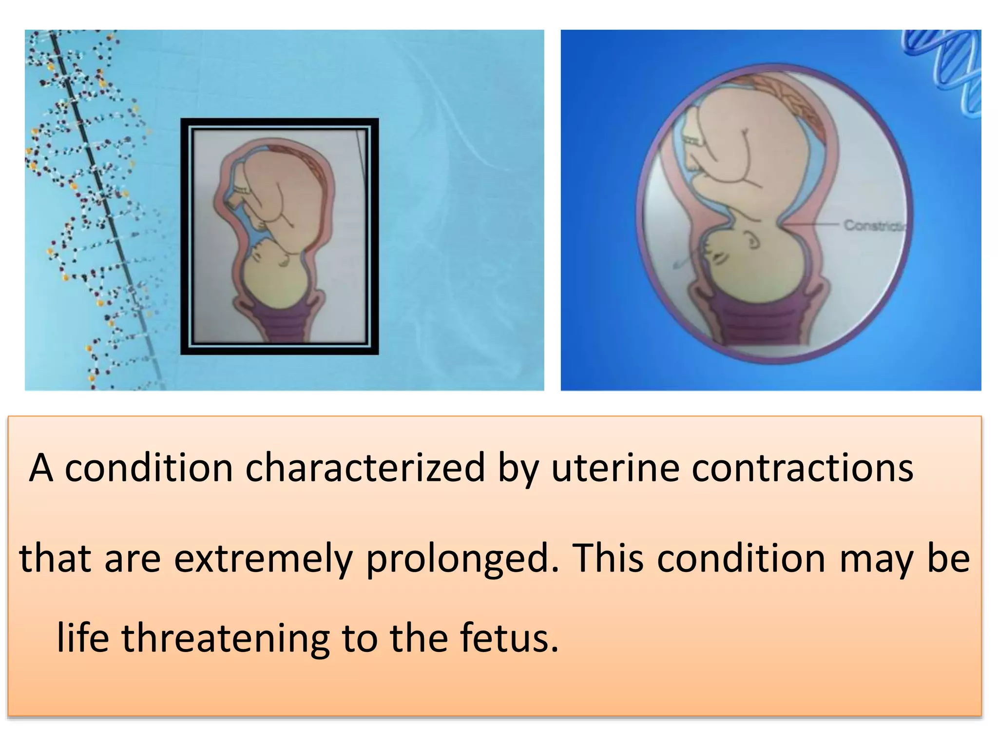 Uterine Inertia, Precipitate Labor and Uterine Tetany | PPTX