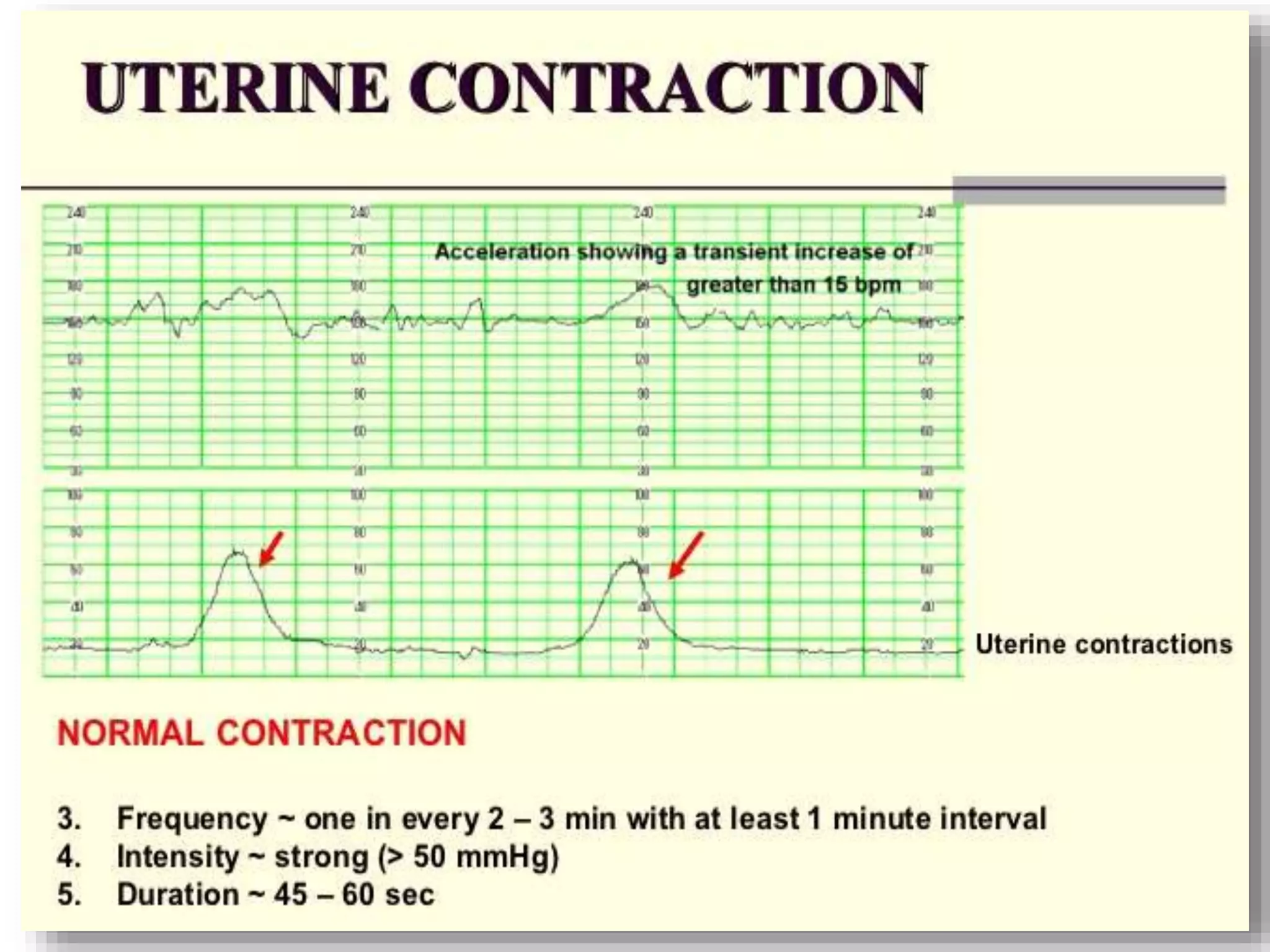 Uterine Inertia, Precipitate Labor and Uterine Tetany | PPTX
