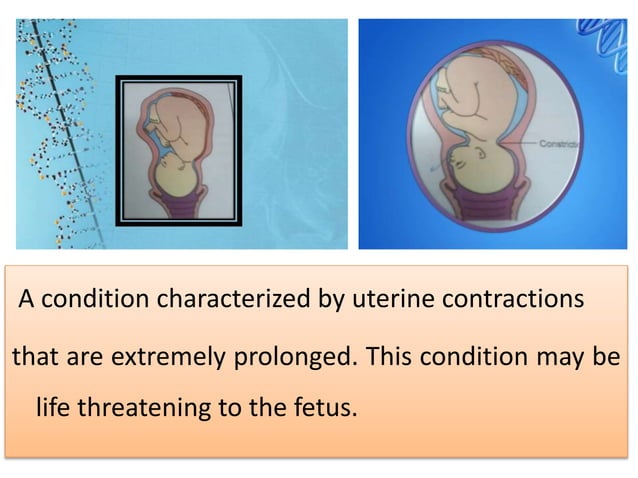 Uterine Inertia, Precipitate Labor and Uterine Tetany | PPTX ...