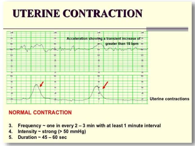 Uterine Inertia, Precipitate Labor and Uterine Tetany | PPTX ...
