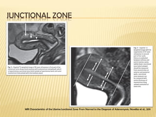 Uterine Tumours | PDF