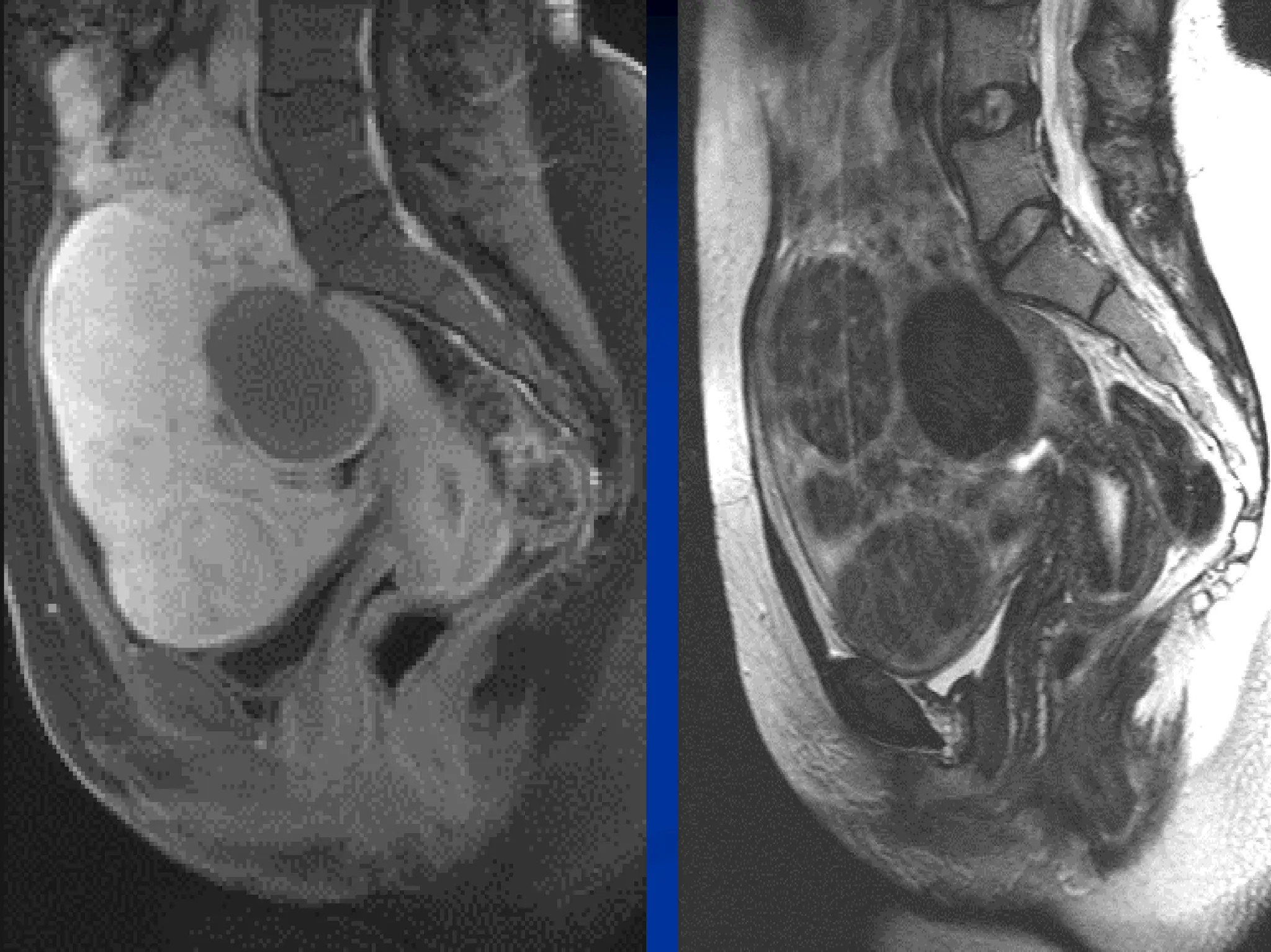UTERING-FIBROID-1.pdf-lecture gynaecology | PPT