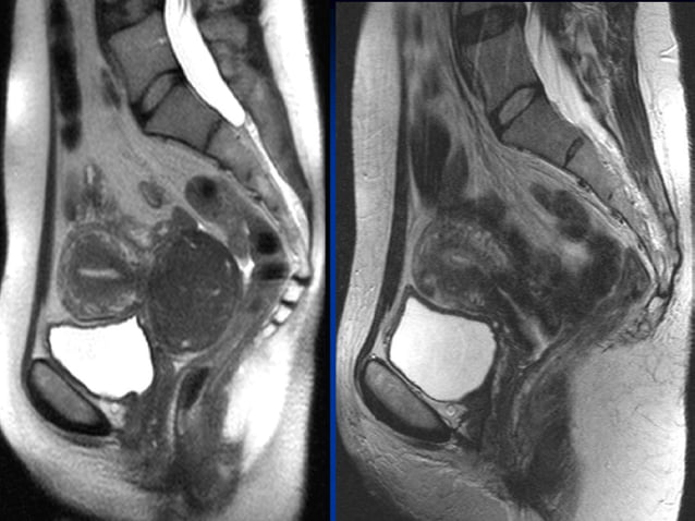 UTERING-FIBROID-1.pdf-lecture gynaecology | PPT