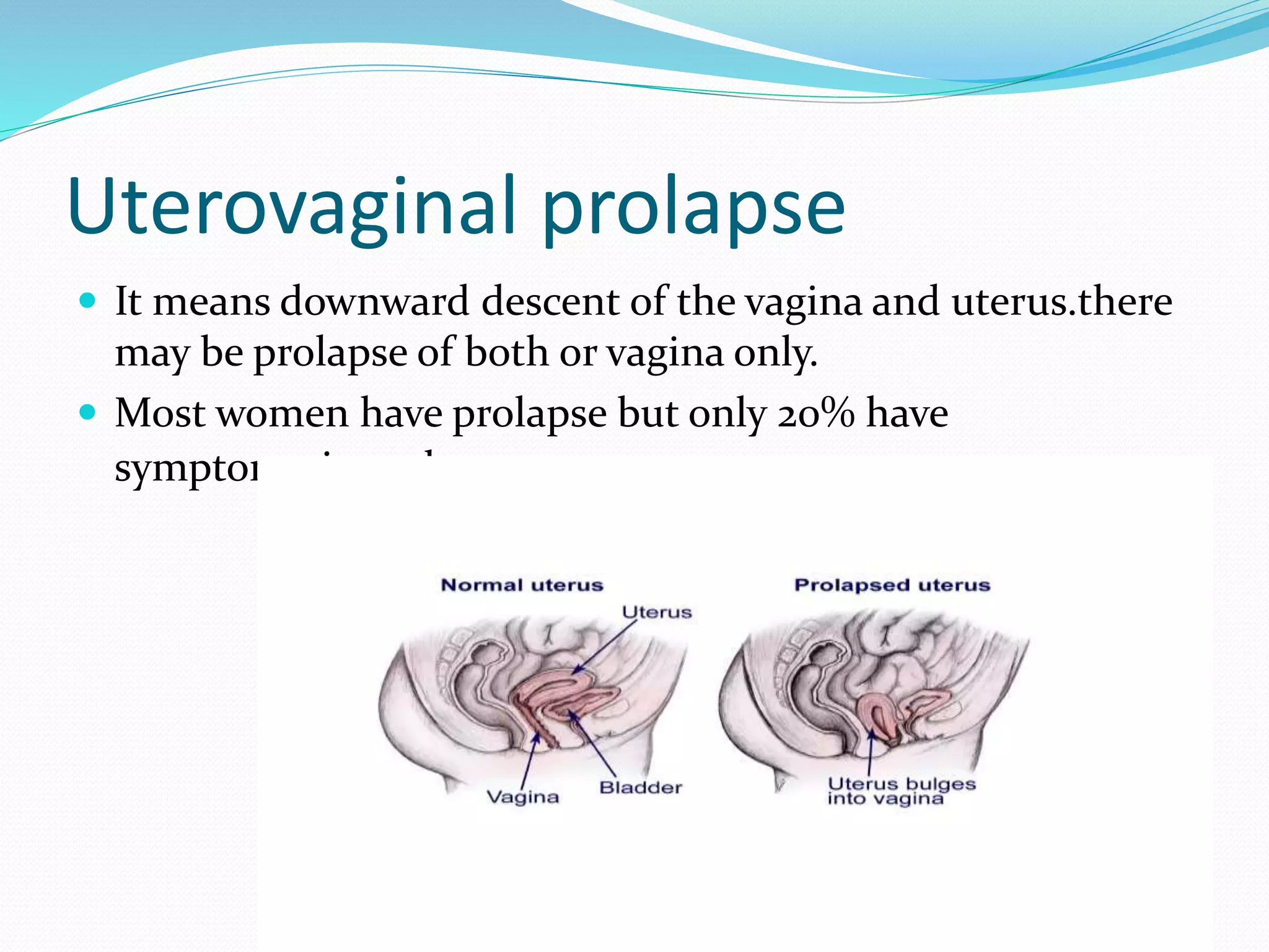 Uterovaginal Prolapse By Dr Zarkaish Pptx
