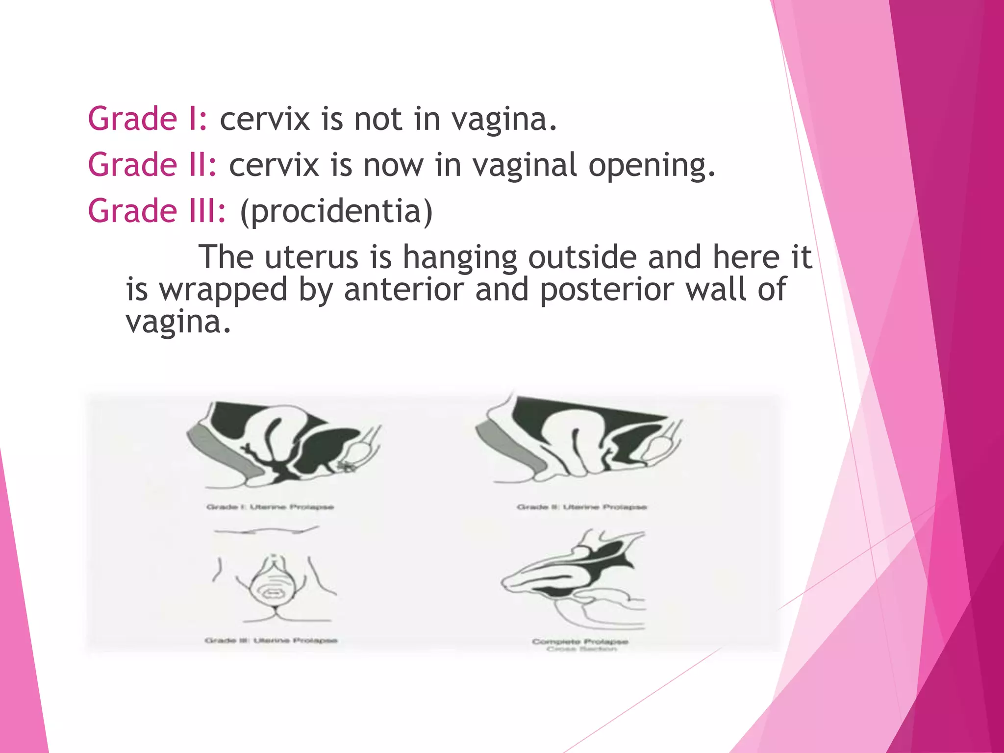 Uterovaginal prolapse By Dr rizwan ullah khan | PPTX